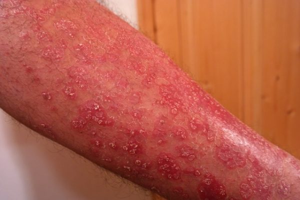 Erythème noueux : causes, symptômes et traitement - avec photos ...