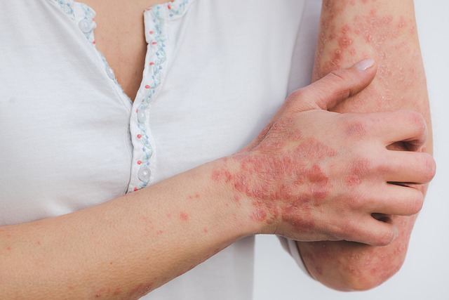 Psoriasis en gouttes : symptômes et traitement - Detective Santé : le blog